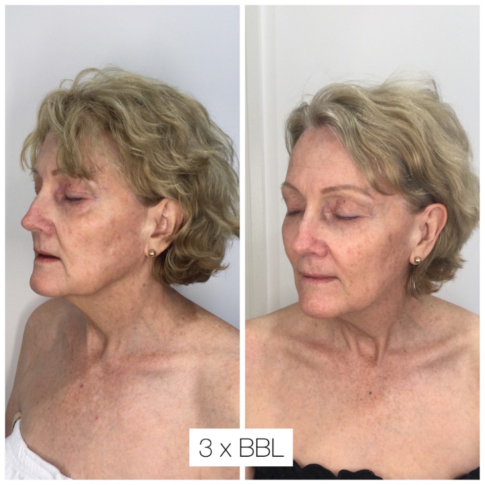 BBL Laser Brisbane & Cairns | Jade Cosmetic Clinic