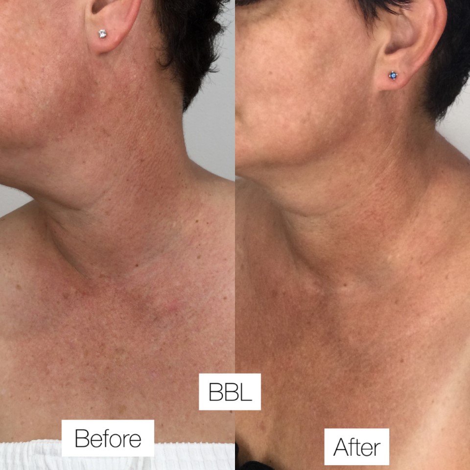 BBL Laser Brisbane & Cairns | Jade Cosmetic Clinic